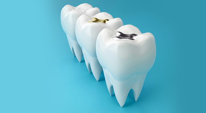 Tooth-Colored Fillings in Hackensack, NJ | Natural-Looking Cavity Repair